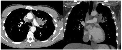 Transformed Testicular Teratoma To Embryonic Type Neuroectodermal Tumor
