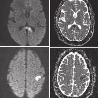 A And B Diffusion Weighted Imaging And Apparent Diffusion Coefficient Download Scientific