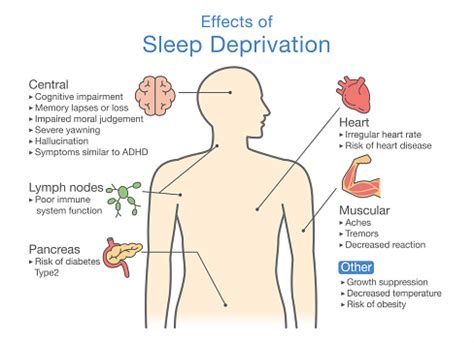 Diagram Of Effects Of Sleep Deprivation Stock Illustration Download
