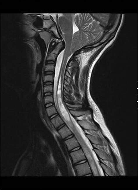 Complex Chiari Malformation There Is Chiari 15 Malformation Descent