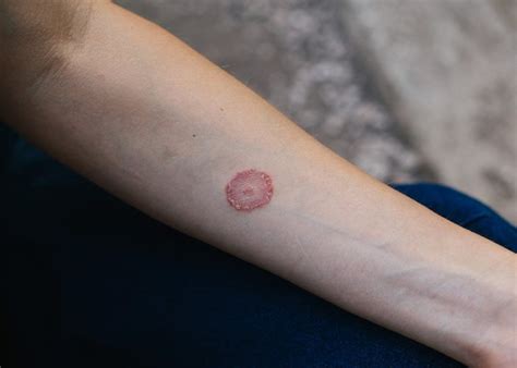 Kucing Gatal Gatal Bisa Jadi Kucing Terkena Ringworm Apa Kenapa Dan