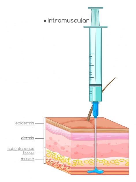 Diagrama Mostrando Injeção Intramuscular Vetor Premium
