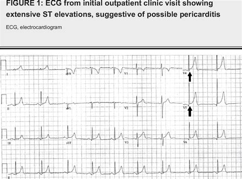 Constrictive Pericarditis Ecg