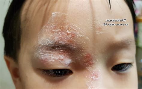 유아 농가진 전염 증상 연고 치료 주의사항 네이버 블로그 유아 농가진 전염 증상 연고 치료 주의사항 네이버 블로그