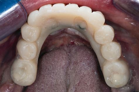 Premium Photo Fixed Denture In The Oral Cavity