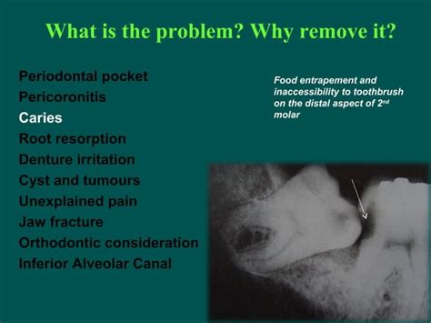 Lower 3rd Molar Impactionits Assessment And The Buccal Approach Vz The