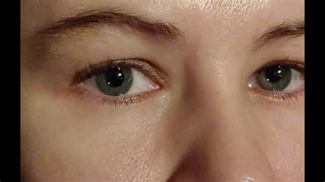Flickering Side Light After Cataract Surgery Shelly Lighting