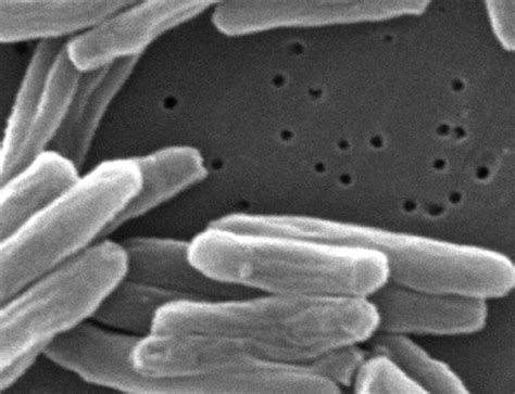 Multnomah County Health Department Investigates Tuberculosis Case At