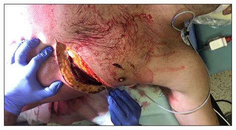 Anterolateral Thoracotomy