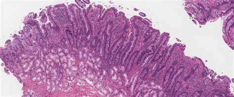 Celiac Disease Mypathologyreport