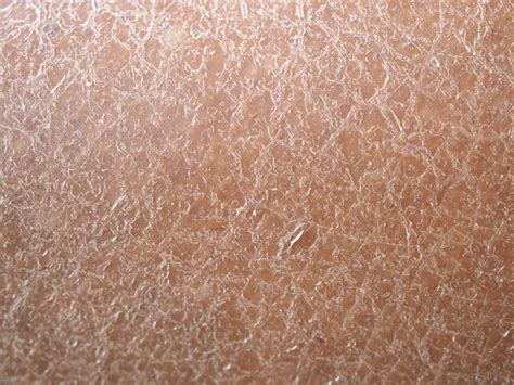 Dry Skin Treatment Fairview Dermatology