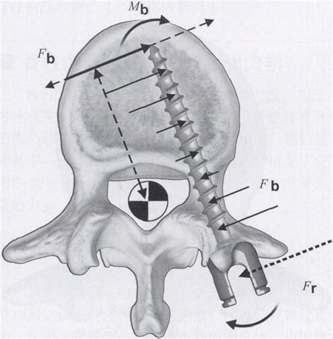应用矫形力恢复冠状面和矢状面侧凸 外科学 医学