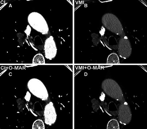 Reduction Of Artifacts From Contrast Media In Spectral Detector Ct By