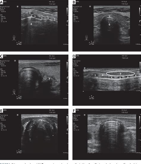 Figure 2 From Ultrasound Guided Percutaneous Tracheostomy Semantic