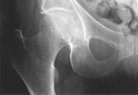 Hip Fracture X Ray