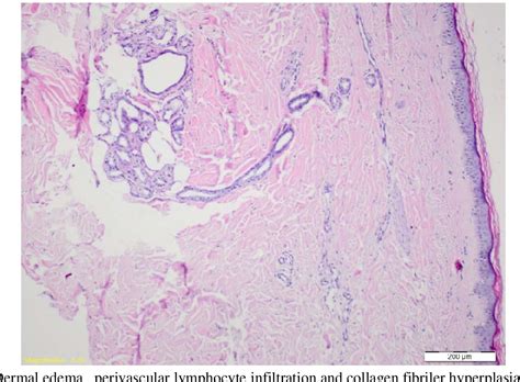 [pdf] Recurrent Ovary Cancer Presenting With Scleroderma A Rare Case Report Semantic Scholar