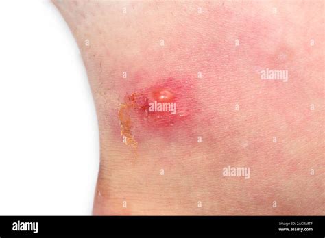 Not For Use In Television Not For Use In Television Cellulitis Caused