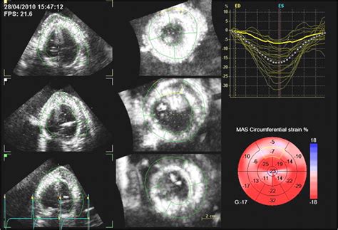 Abstract 12781 A New High Resolution 3d Echo Based Strain Method Gives