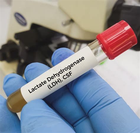 Csf Sample For Ldh Lactate Dehydrogenase Test Stock Image Image Of