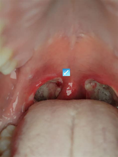 Tonsillectomy Infected Rtonsilstones