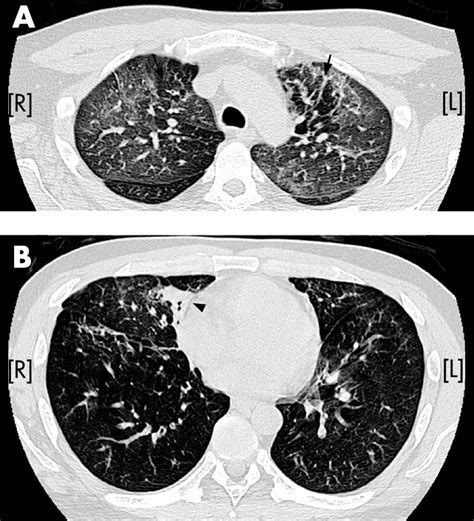 Bronchiolitis Obliterans