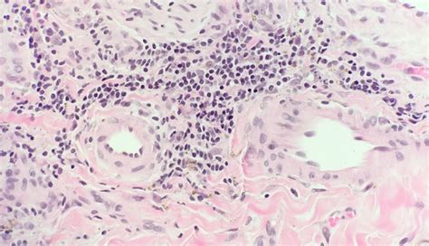 Successful Treatment Of Pyoderma Gangrenosum With Cryoglobulinemia And Hepatitis C Pmc