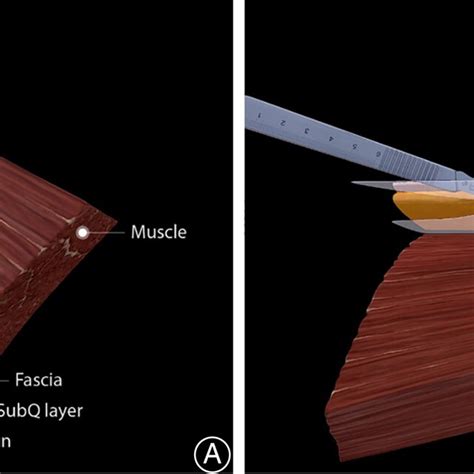 Illustration Of The Interrupted Incision Fasciotomy Technique A The Download Scientific