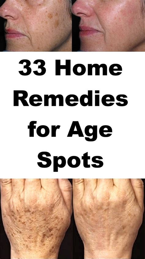 Does Lemon Juice Really Remove Age Spots At Stephen Jamerson Blog