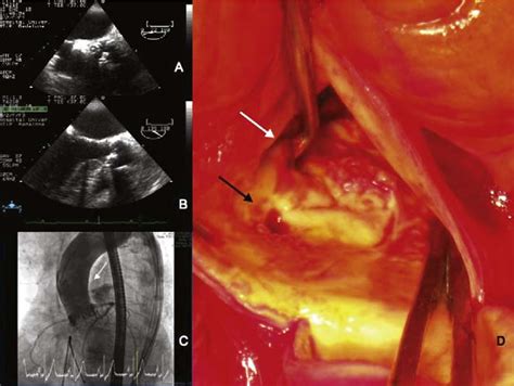 Figure 1 From Aortic Root Rupture During Trans Catheter Aortic Valve Implantation Semantic