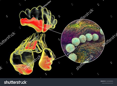 Streptococcus Pyogenes Bacteria Cause Sinusitis 3d Stock Illustration
