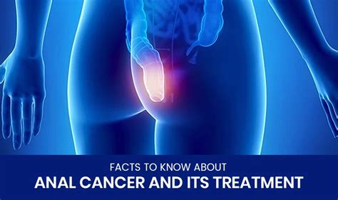 Anal Cancer Lump