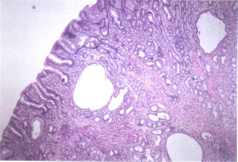 Hyperplastic Surface Epithelium And Cystically Dilated Glands With