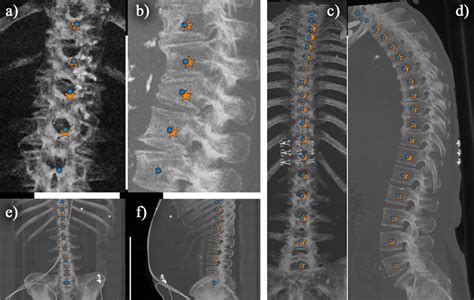 Several Examples Of False Positives On The Verse Dataset In Sagittal