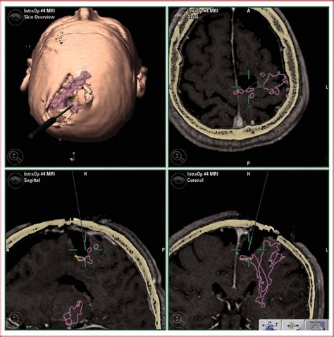 Figure 2 From Evaluation Of Diffusion Tensor Imagingbased Tractography