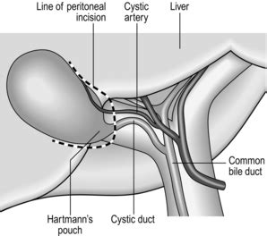 Gallbladder Anatomy Hartmann Pouch