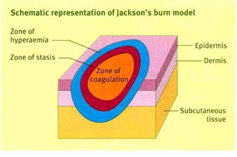 Burn Care Flashcards Quizlet