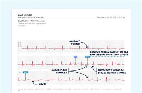 Ectopic Atrial Rhythm Vs Premature Atrial Contraction Couplet On Your Watch Ecg Qaly