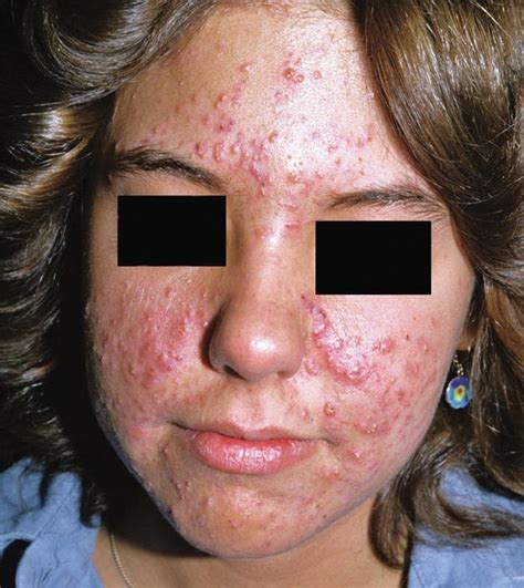 Pustular Eruptions Clinical Tree