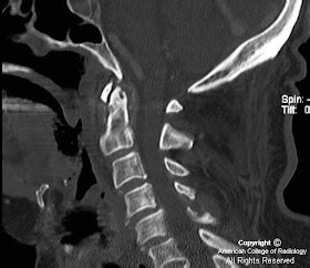 Neuroradiology On The Net CPPD Of The Cervical Spine Crown Dens Syndrome
