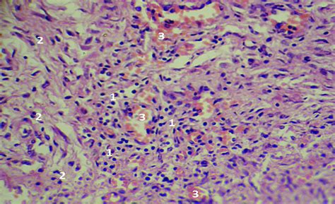 Microscopic View Of The Laparotomy Wound Granulation Tissue On The