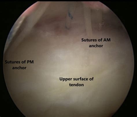 Arthroscopic View Of The Right Shoulder Subacromial Space Through The Download Scientific