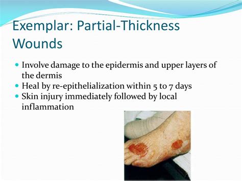 Ppt Alterations In Skin Integrity And Would Healing Powerpoint