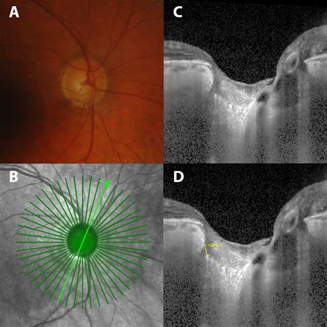 Association Between Focal Lamina Cribrosa Defects And Optic Disc