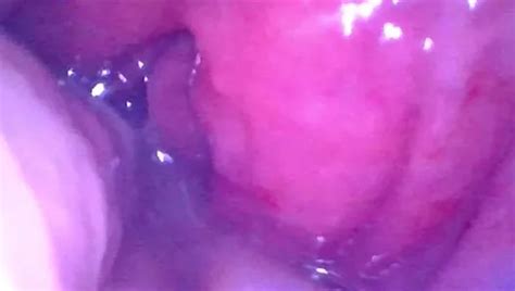 Look Inside Urethra And Bladder With Endoscope Japanese Gay Small Cock