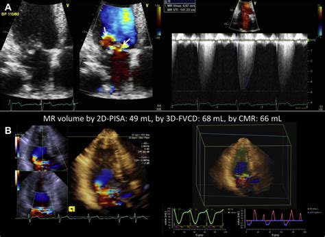 clinical implications of three dimensional real time color doppler