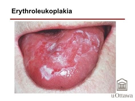Oral Pathology