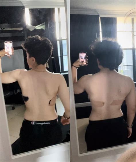 Burning Sensation After Injection R Testosteronekickoff