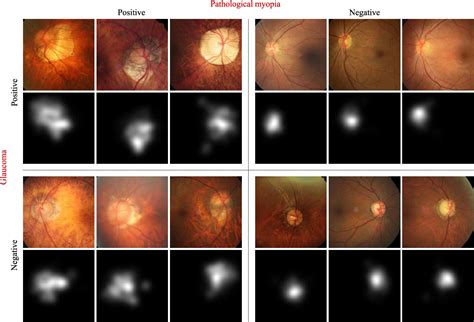 Figure 4 From A Large Scale Database And A Cnn Model For Attention Based Glaucoma Detection