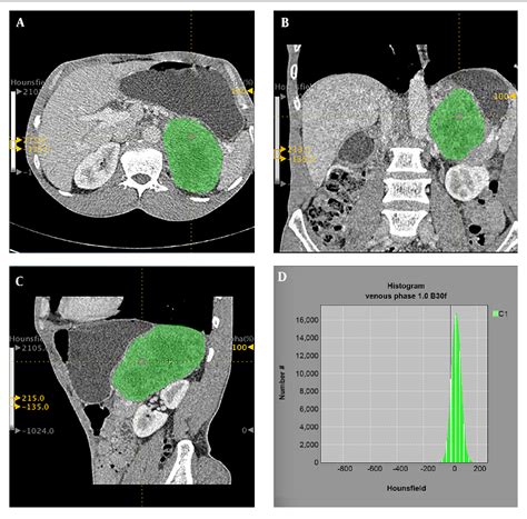 Figure 2 From Value Of Ct Based Texture Analysis In Preoperative
