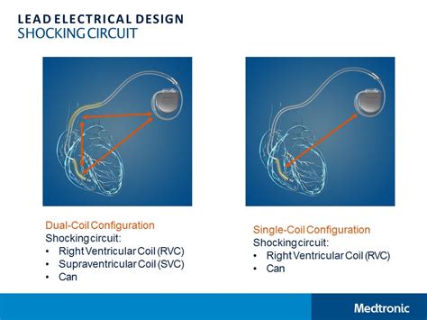 Cvt Mohd Farid Concept Of Icd Technology Sensing And Detection Medtronic Academy